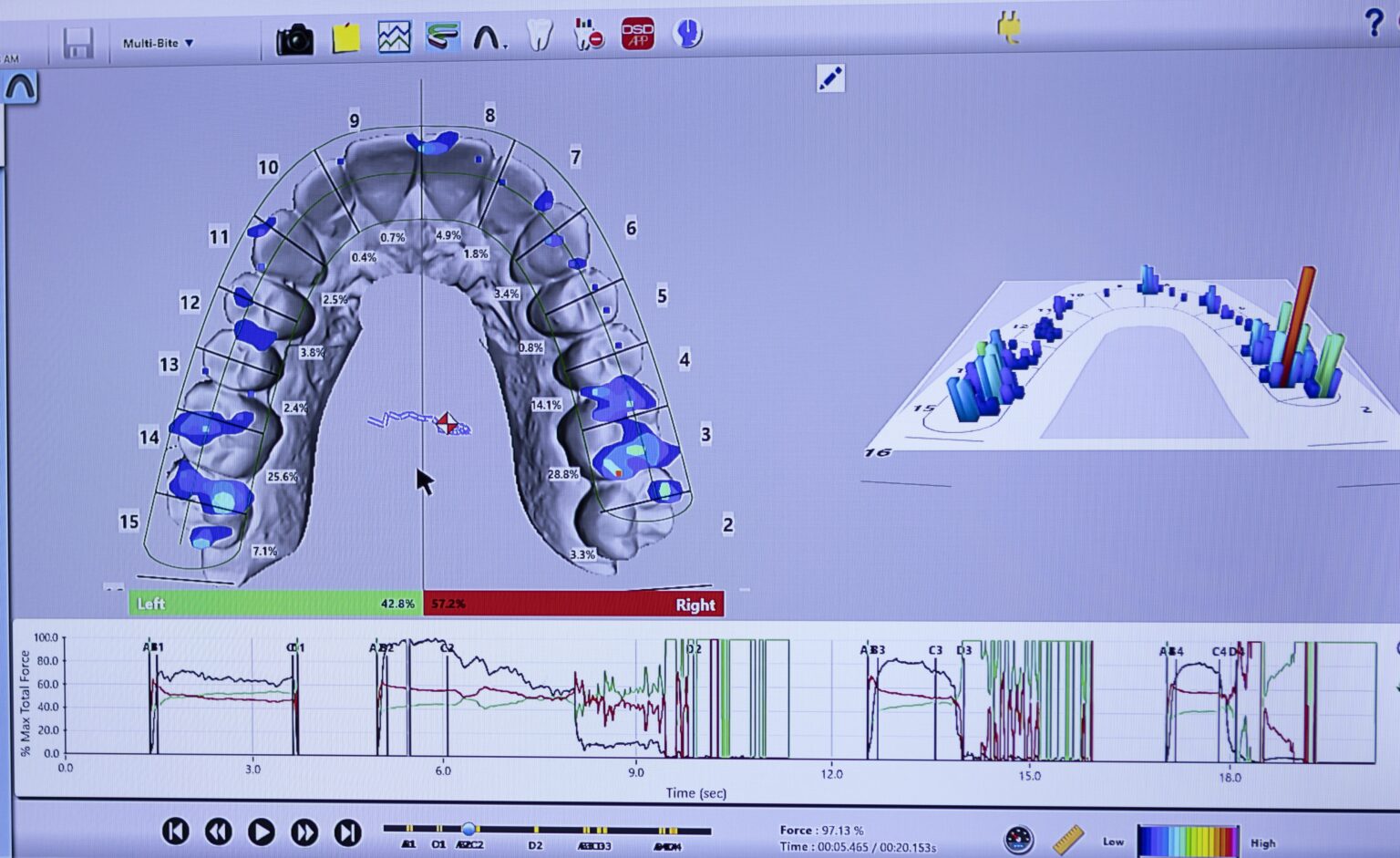 Disclusion Time Reduction Therapy - Orcutt Family Dentistry
